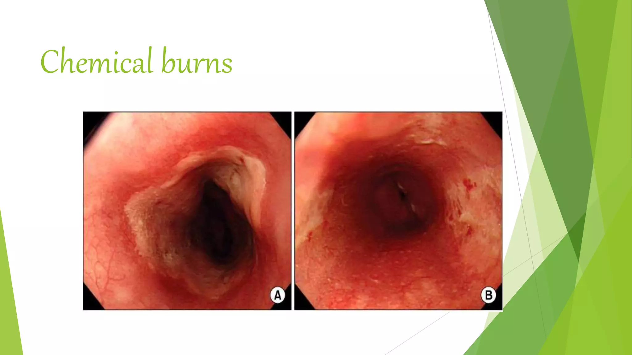 Foreignbodies and chemical burns of the esophagus.pptx