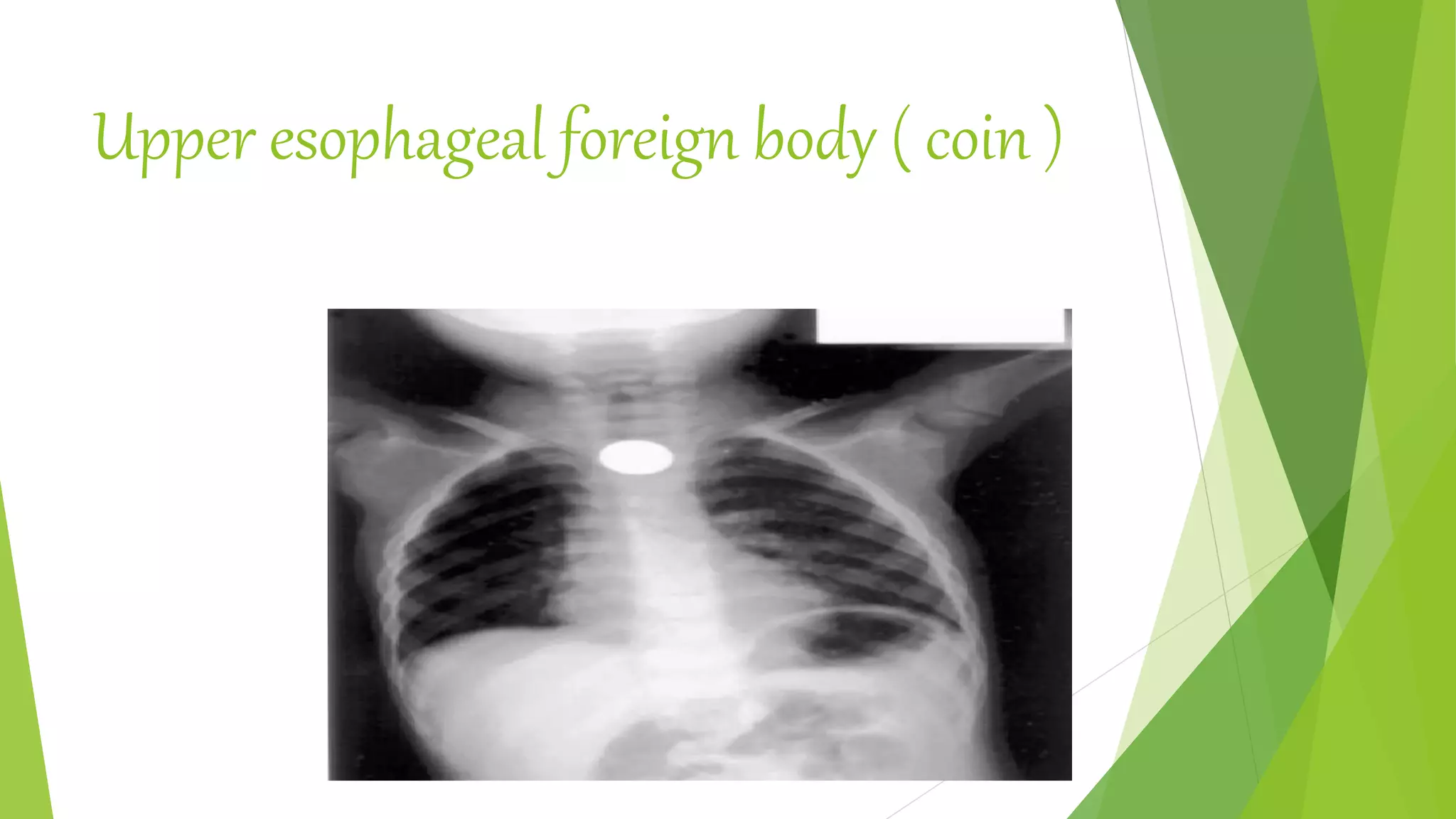 Foreignbodies and chemical burns of the esophagus.pptx