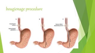 Foreignbodies and chemical burns of the esophagus.pptx