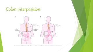 Foreignbodies and chemical burns of the esophagus.pptx