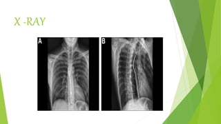 Foreignbodies and chemical burns of the esophagus.pptx