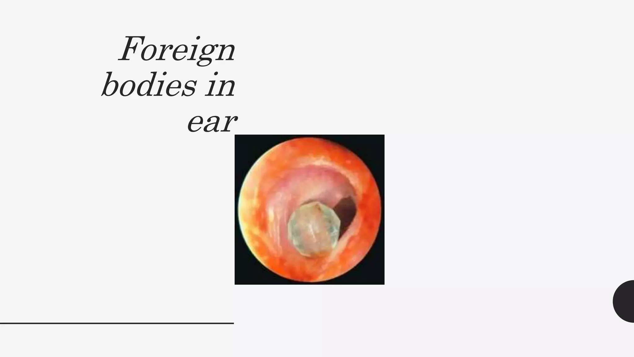 Foreign bodies in ear and other topics | PPTX