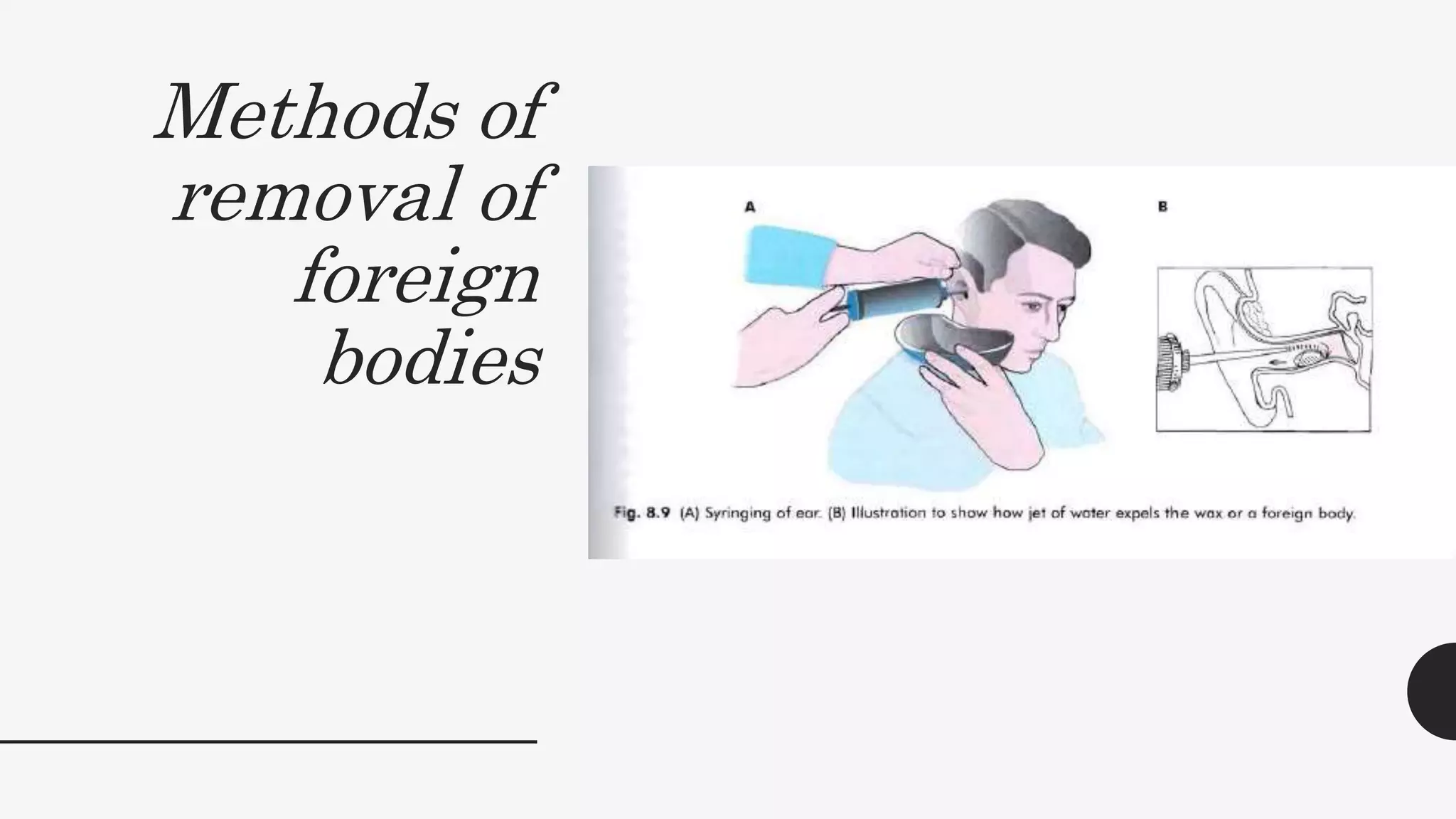 Foreign bodies in ear and other topics | PPTX