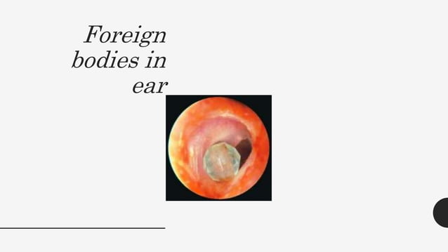 Foreign bodies in ear and other topics | PPTX | Ear, Nose and Throat Conditions | Diseases and ...