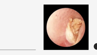 Foreign bodies in ear and other topics | PPTX