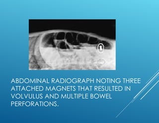 Foreign bodies in Gastro intestinal tract.ppt