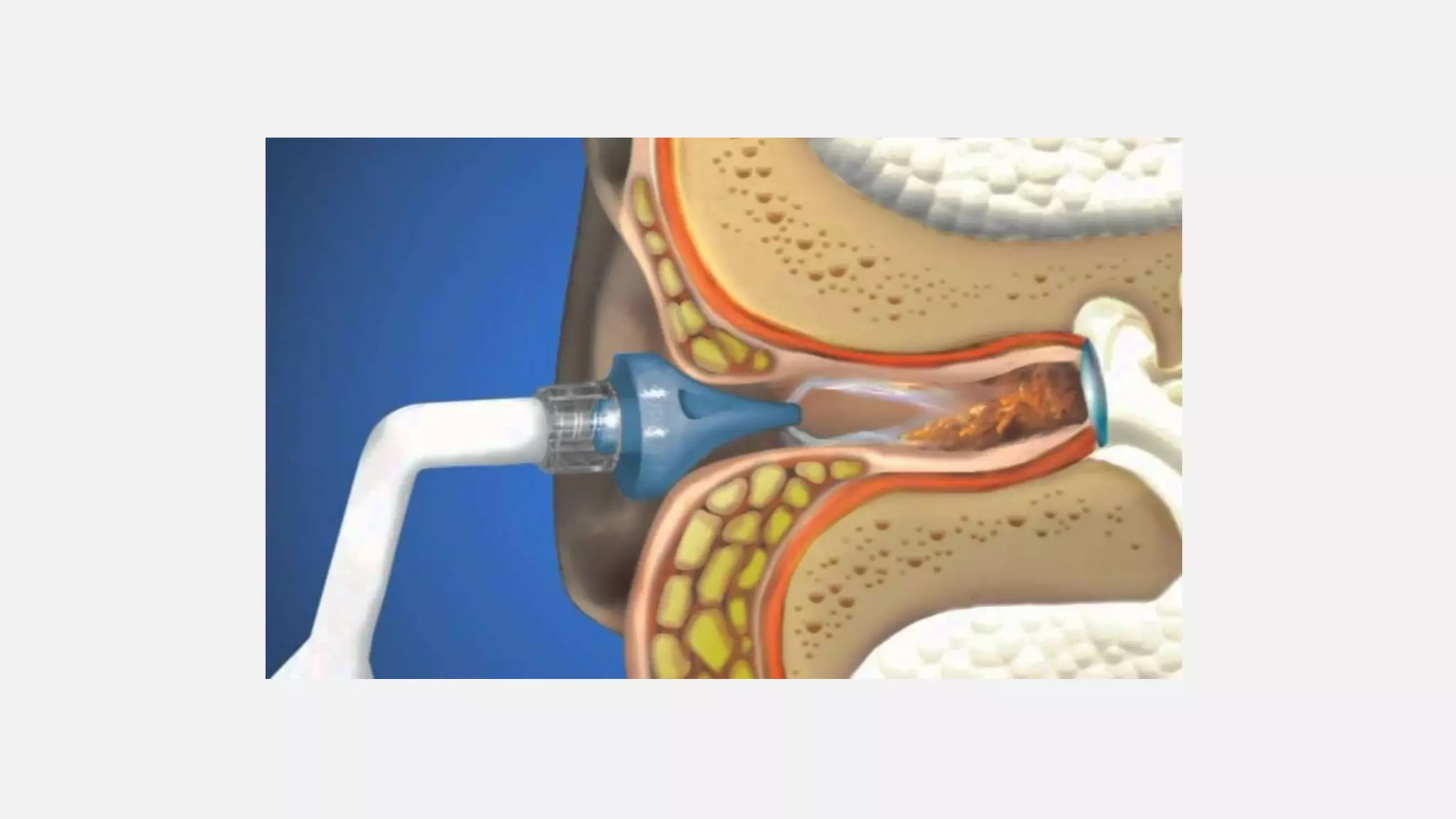 Foreign bodies in the ear | PDF