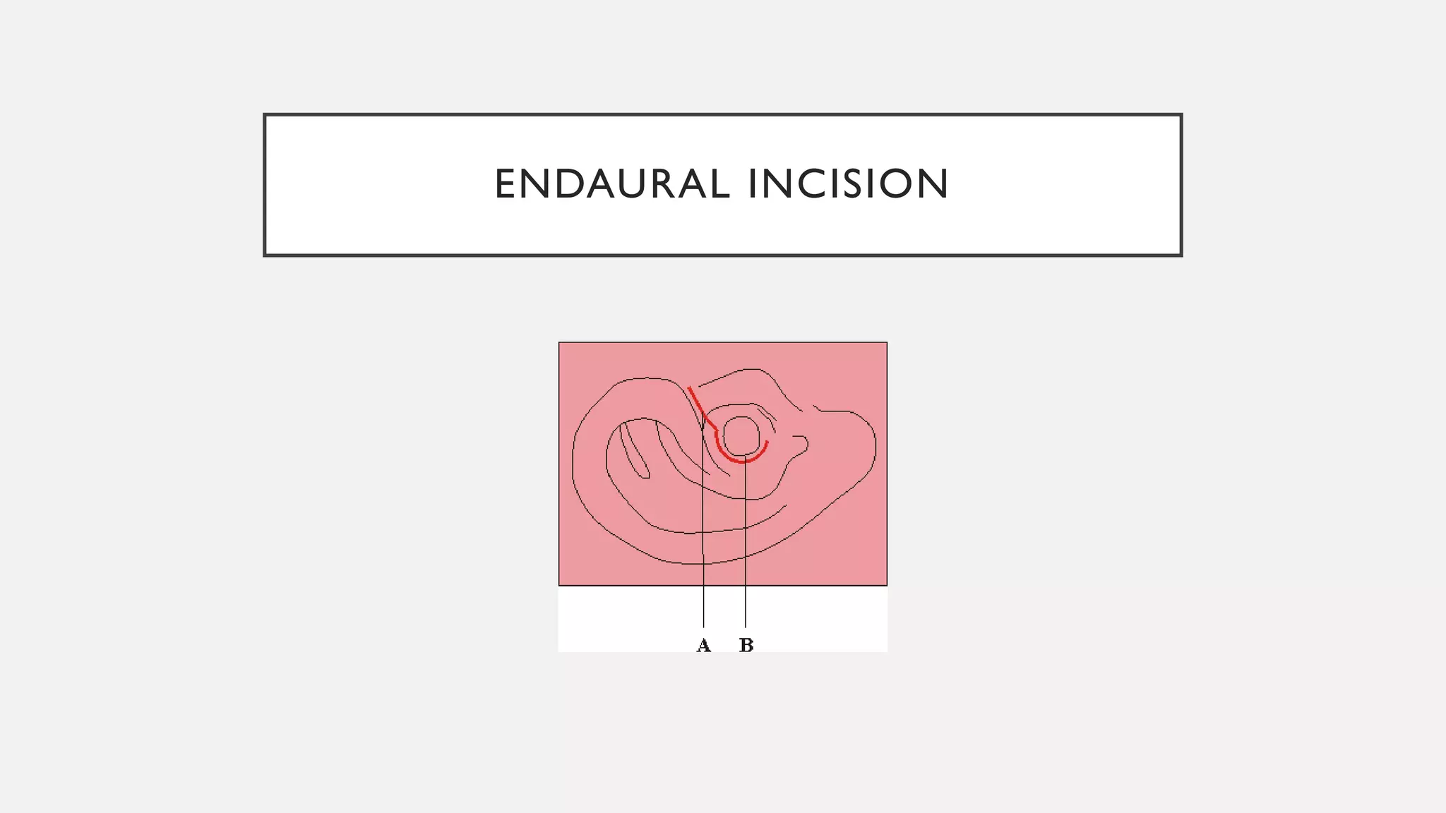 Foreign bodies in the ear | PDF