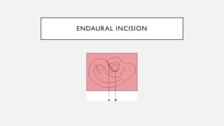 Foreign bodies in the ear | PDF