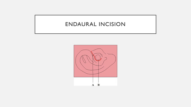 Foreign bodies in the ear | PDF | First Aid | Injuries