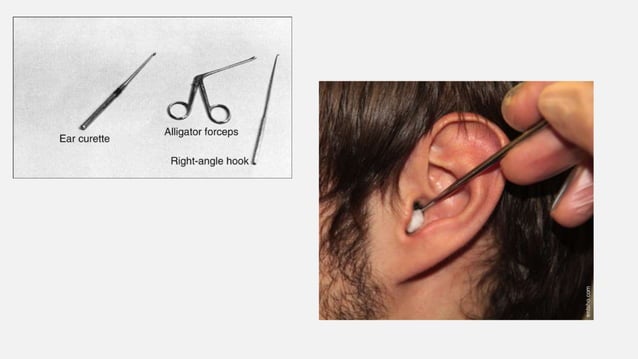 Foreign bodies in the ear | PDF | First Aid | Injuries