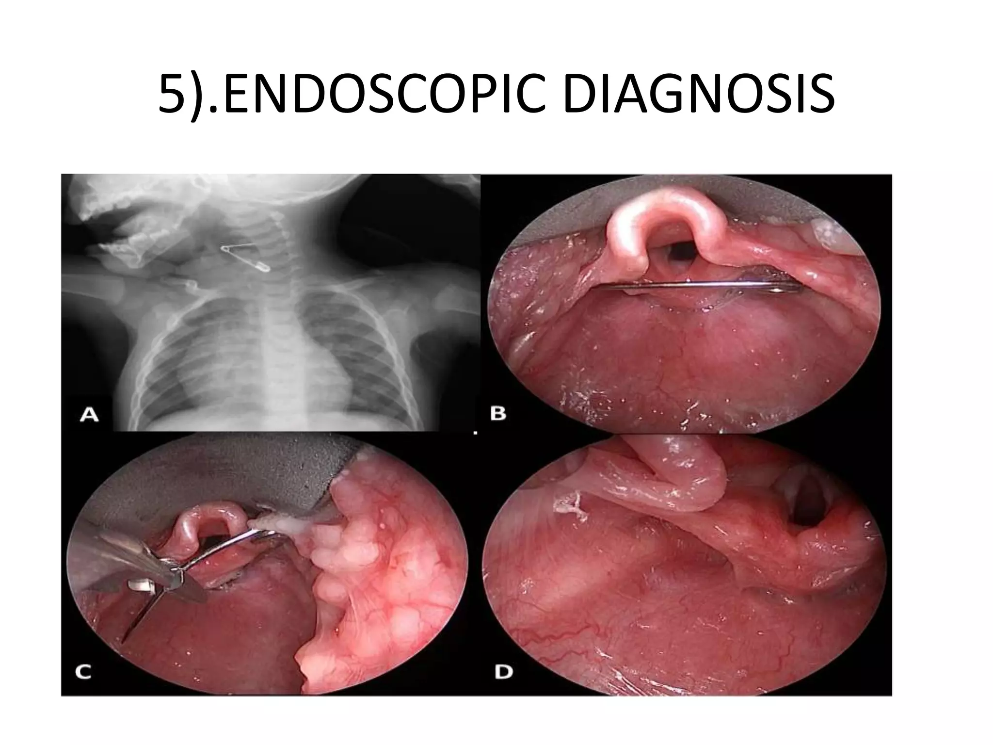 Foreign bodies of air passages | PPTX