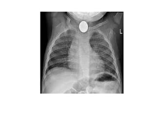FOREIGN BODIES OF FOOD & AIR PASSAGES.pptx