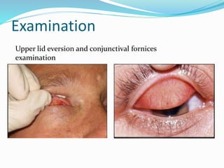 corneal Foreign body In eyes.pptx
