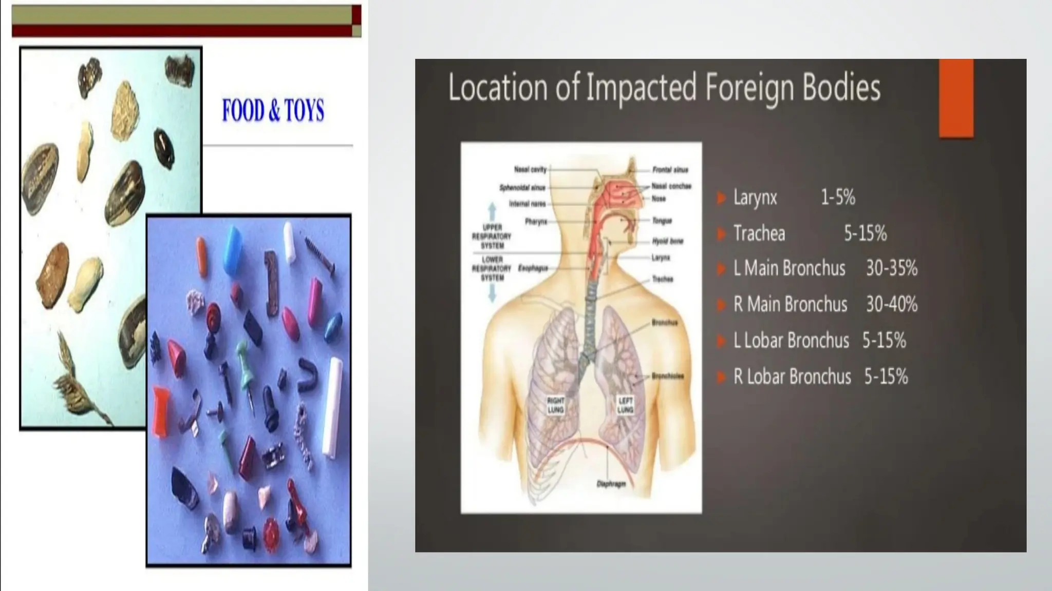 FOREIGN BODY ASPIRATION-1-1 - Copy.pptxv | PPTX