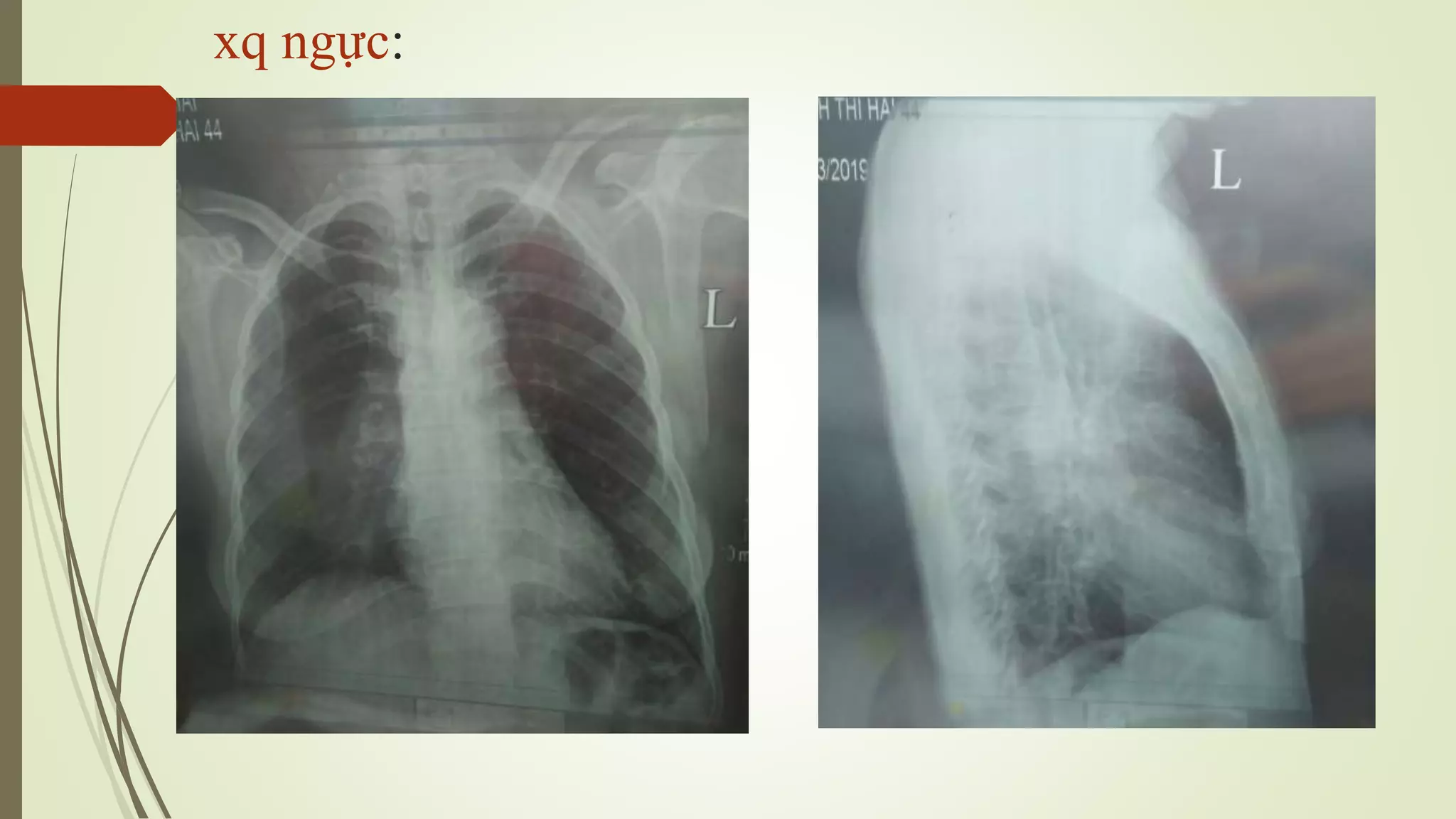Foreign body aspiration | PPTX
