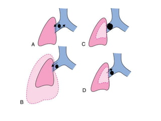 Foreign body aspiration.pptx