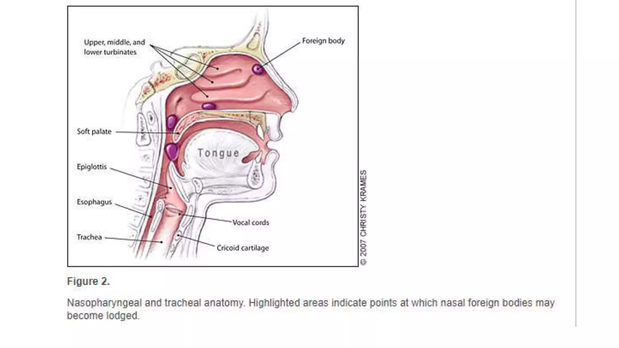 Foreign body in ENT | PPTX