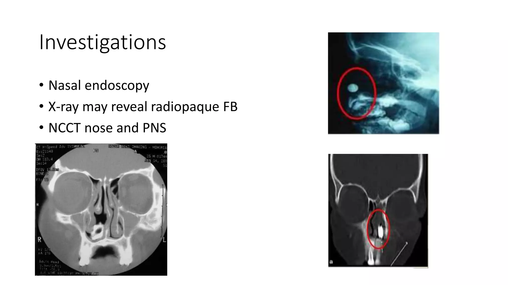 Foreign body in ENT | PPTX