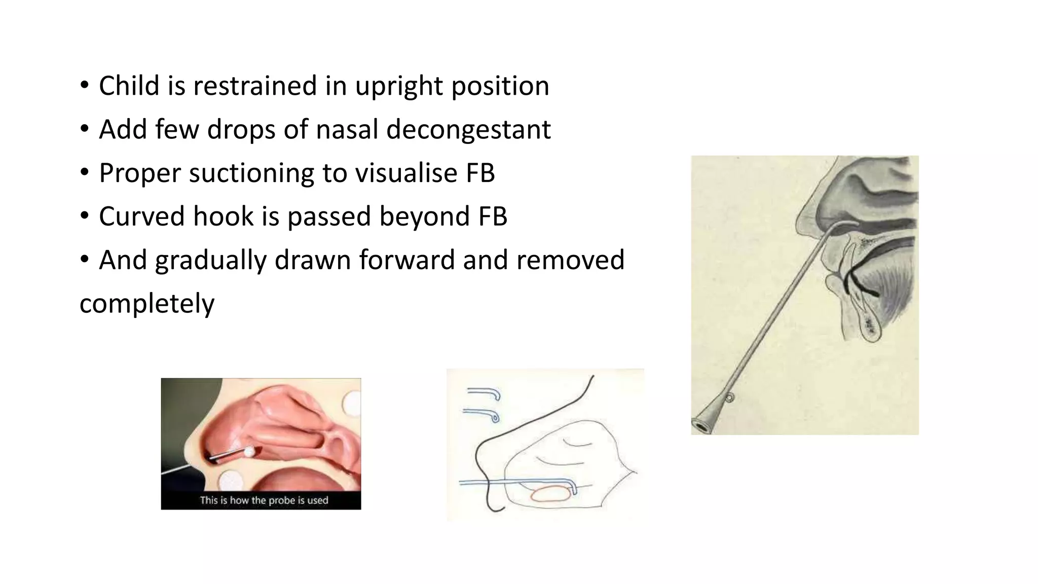 Foreign body in ENT | PPTX