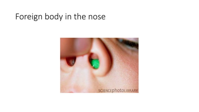 Foreign body in ENT | PPTX