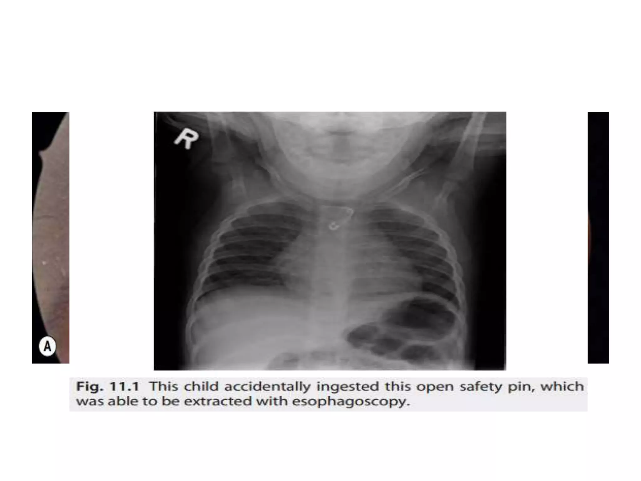 FOREIGN BODY INGESTION & ASPIRATION - 2.pptx