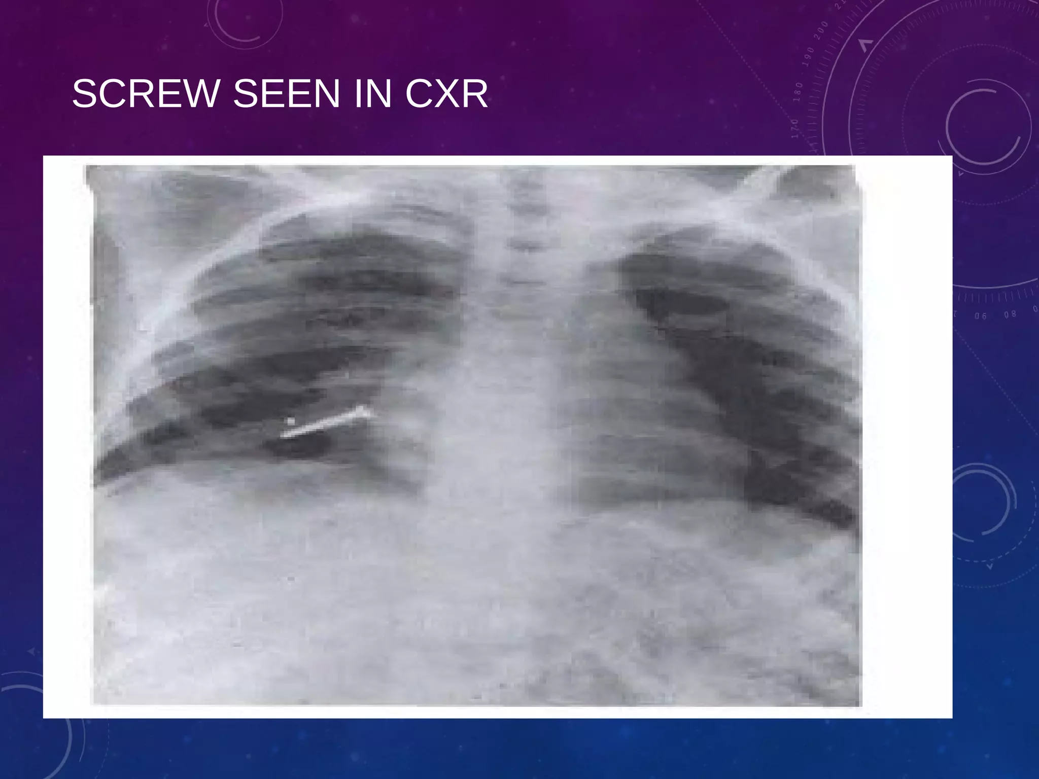 management of foreign body inhalation and bronchoscopy in children | PPT