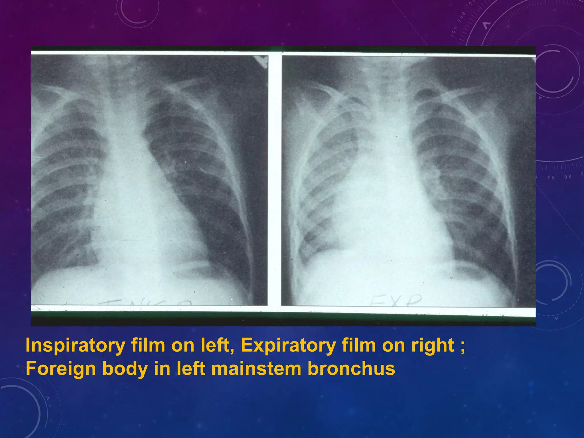 management of foreign body inhalation and bronchoscopy in children | PPT