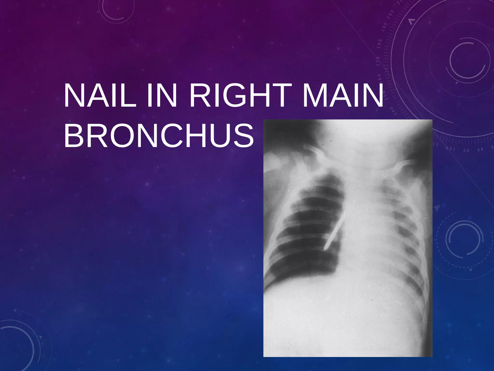 management of foreign body inhalation and bronchoscopy in children | PPT