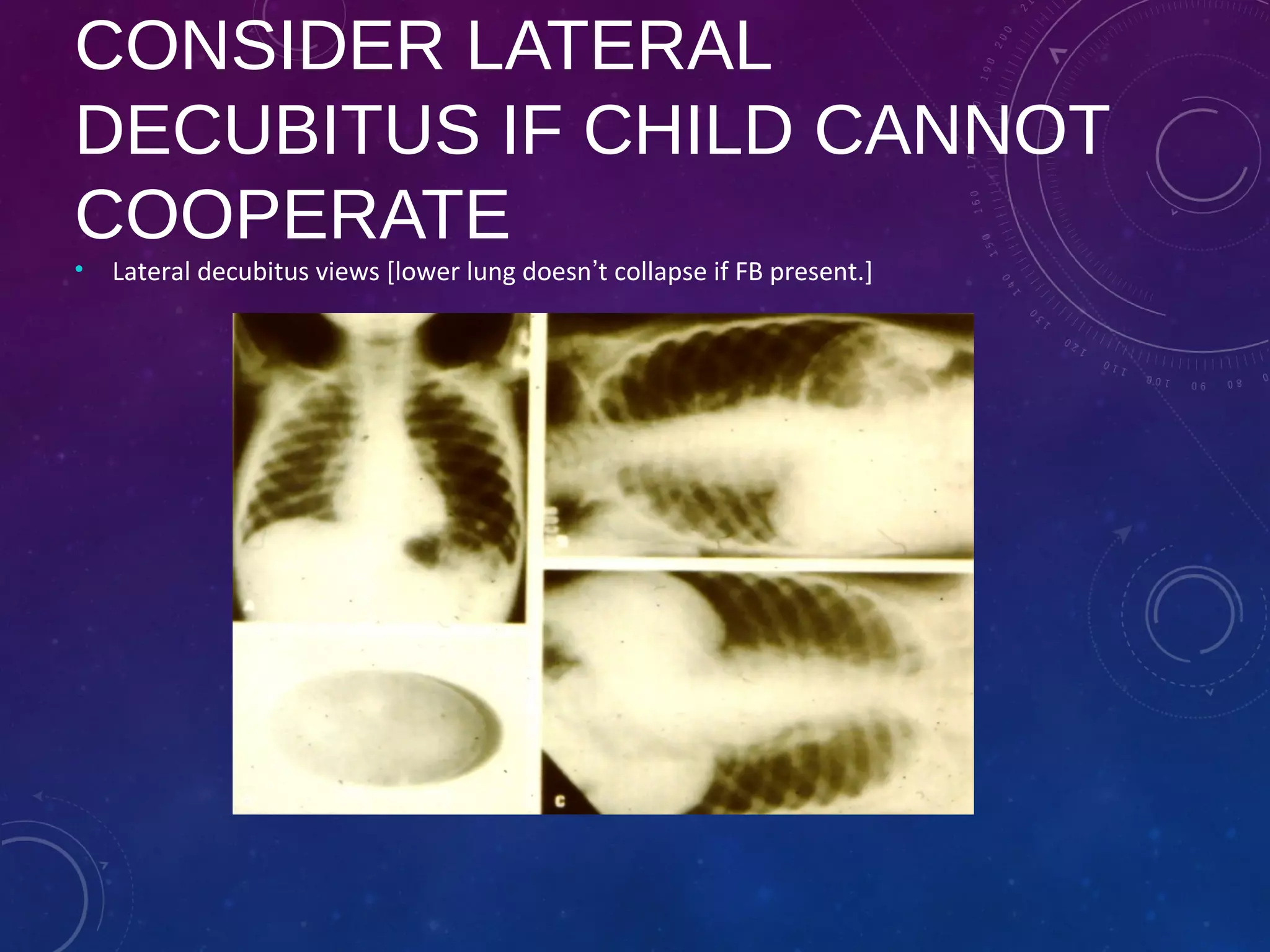 management of foreign body inhalation and bronchoscopy in children | PPT
