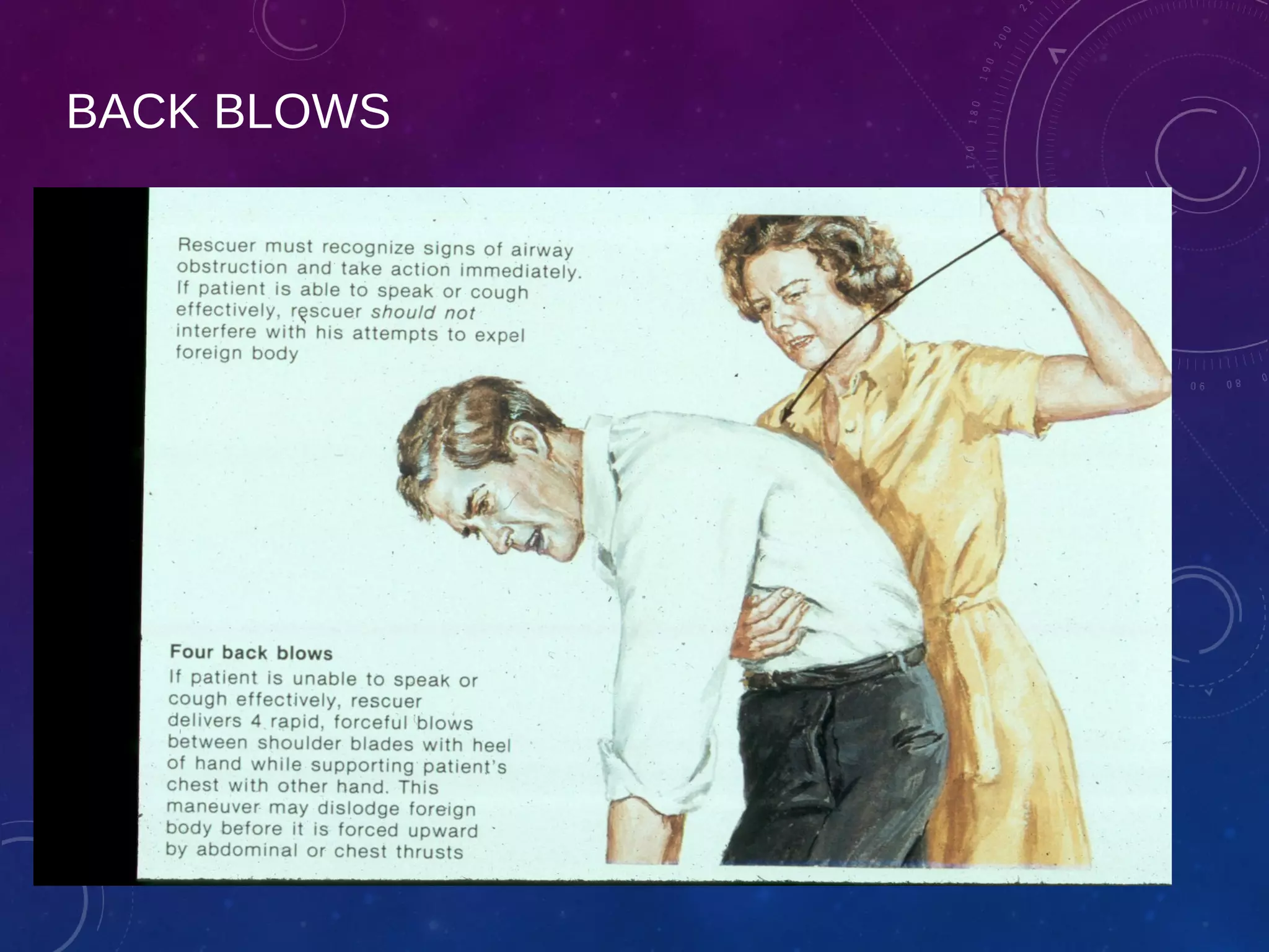 management of foreign body inhalation and bronchoscopy in children | PPT