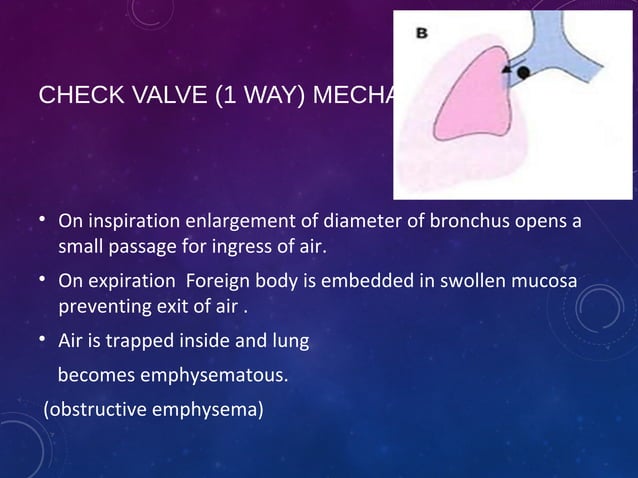 management of foreign body inhalation and bronchoscopy in children | PPT