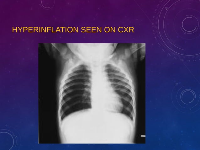 management of foreign body inhalation and bronchoscopy in children | PPT