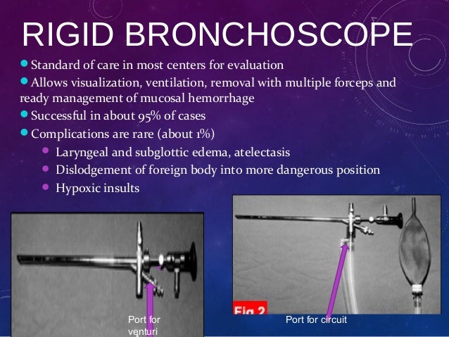 management of foreign body inhalation and bronchoscopy in children