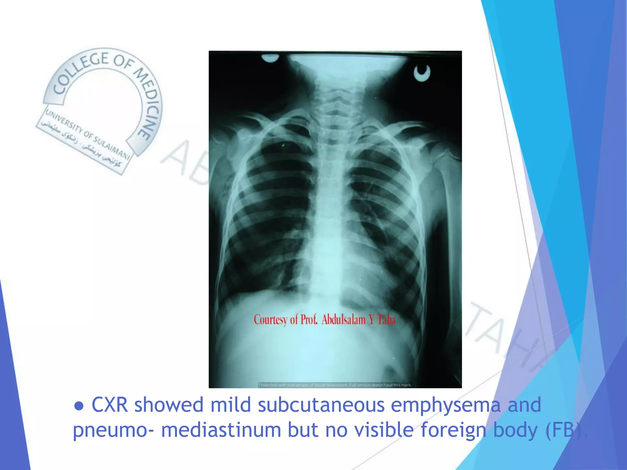 Foreign Body Inhalation with Surgical Emphysema.pdf