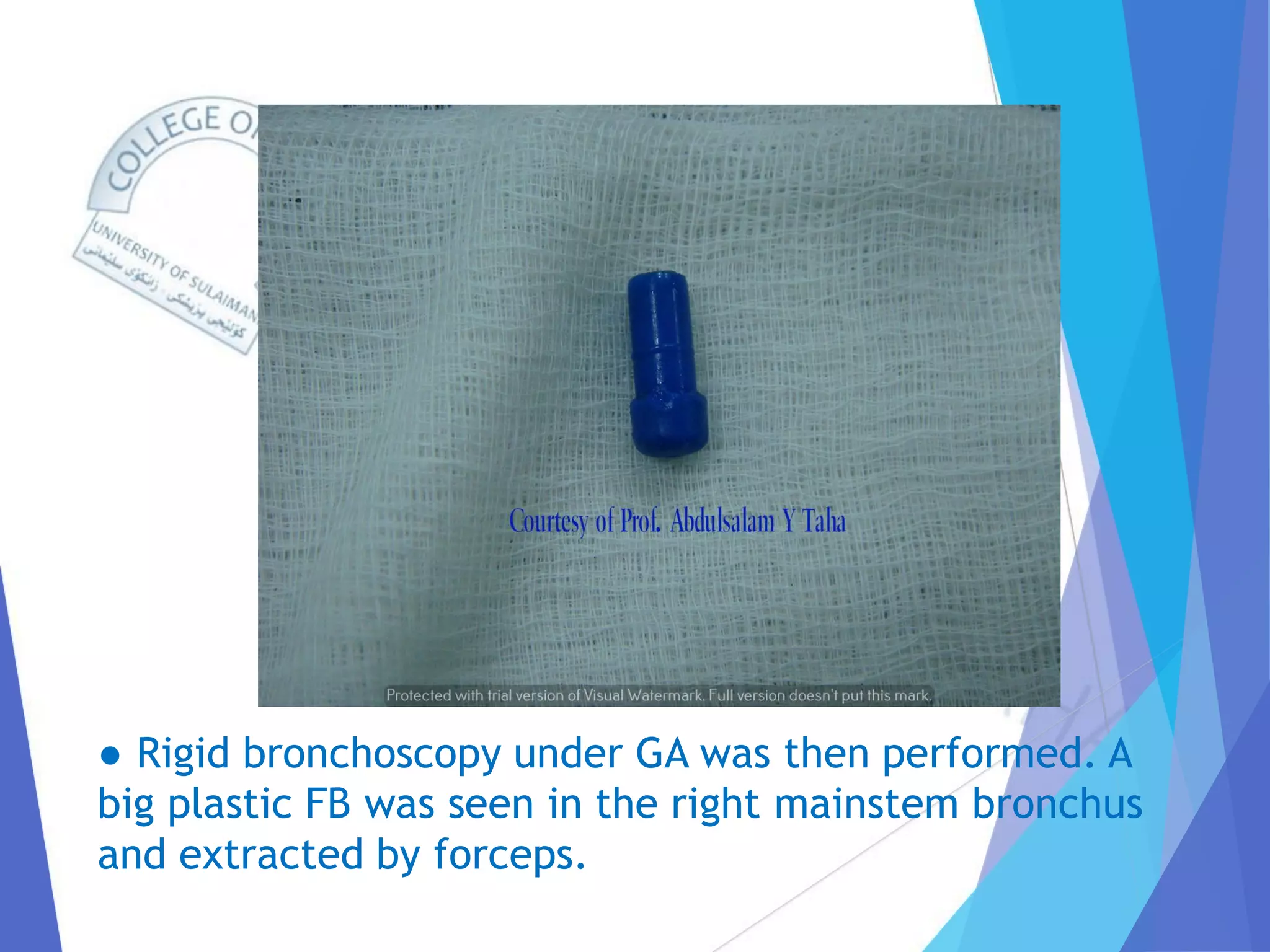 Foreign Body Inhalation with Surgical Emphysema.pdf