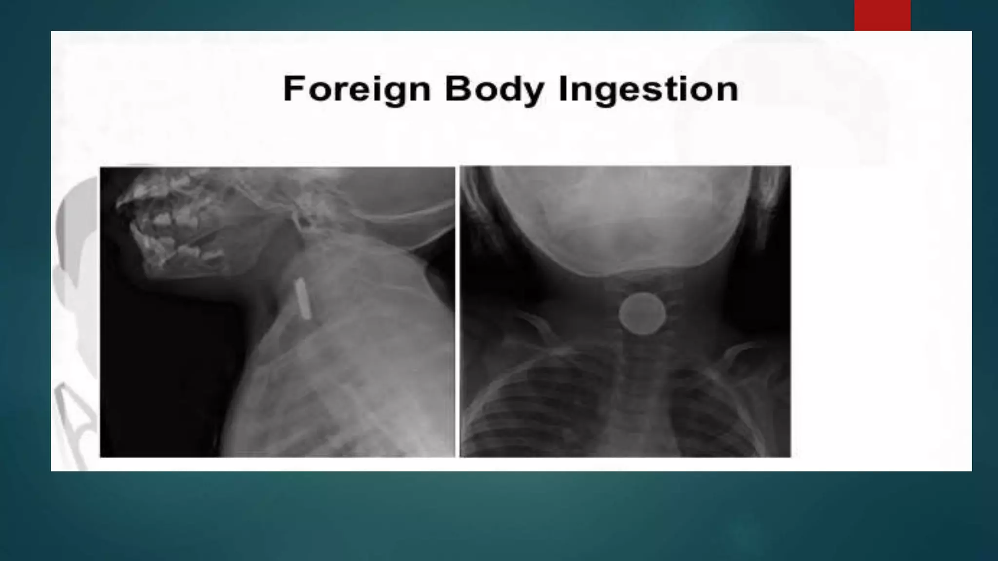 Foreign body in pediatrics | PPTX