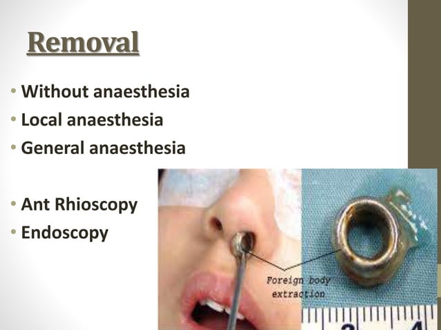 Foreign body nose | PPT