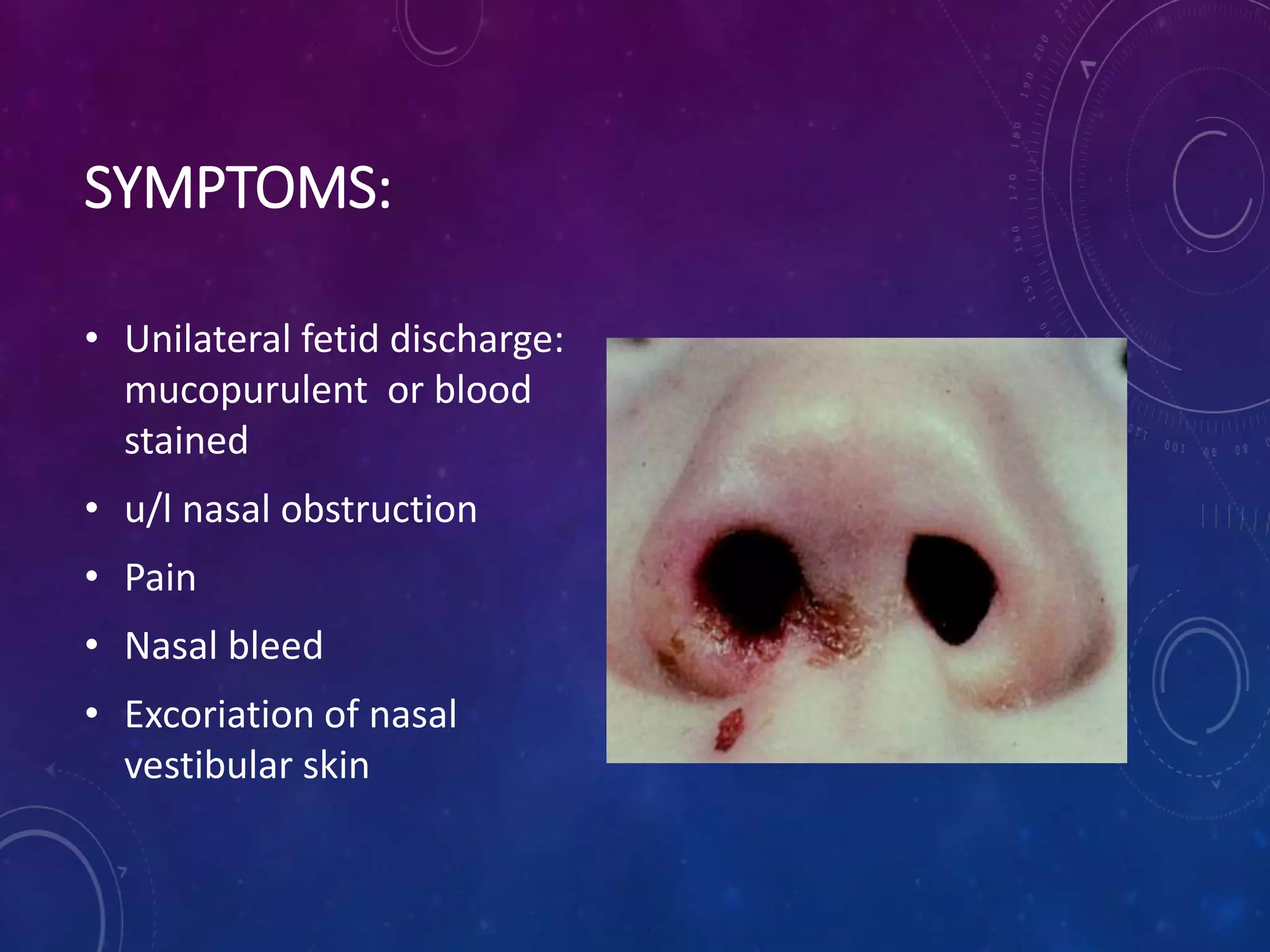 Foreign body nose | PPTX