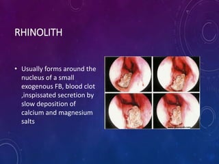 Foreign body nose | PPTX