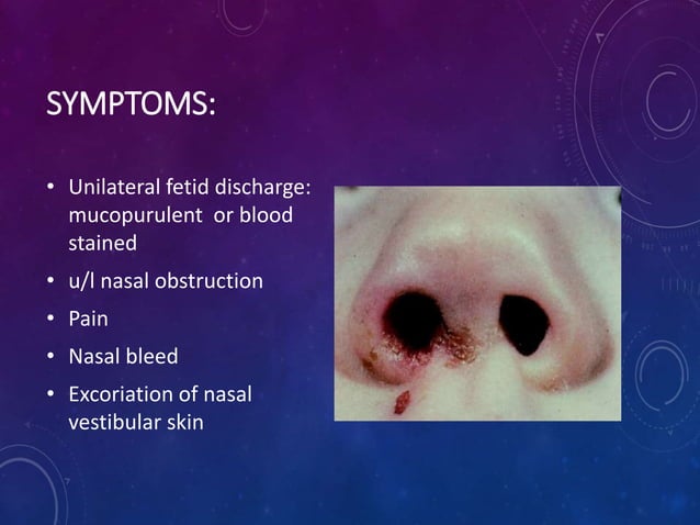 Foreign body nose | PPTX