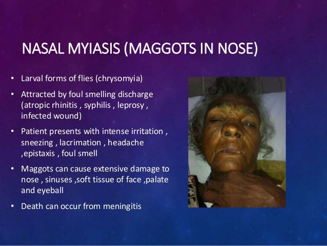 Nasopharyngeal Myiasis Maggots In Nose Nasal Myiasis