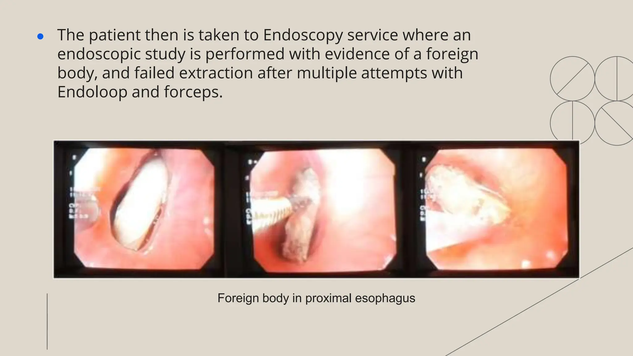 Foreign Body Obstruction - Esophagus.pptx