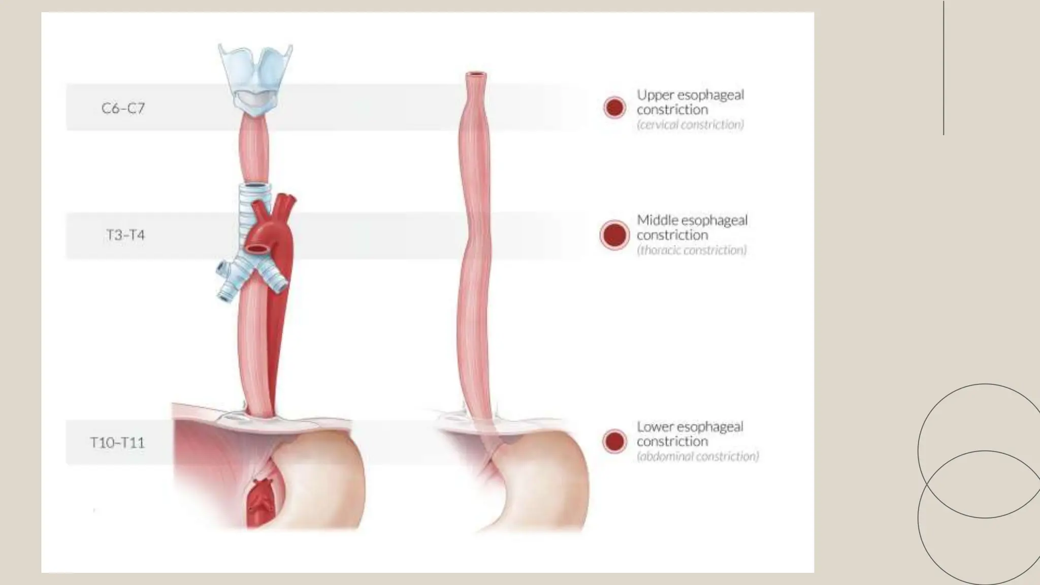 Foreign Body Obstruction - Esophagus.pptx