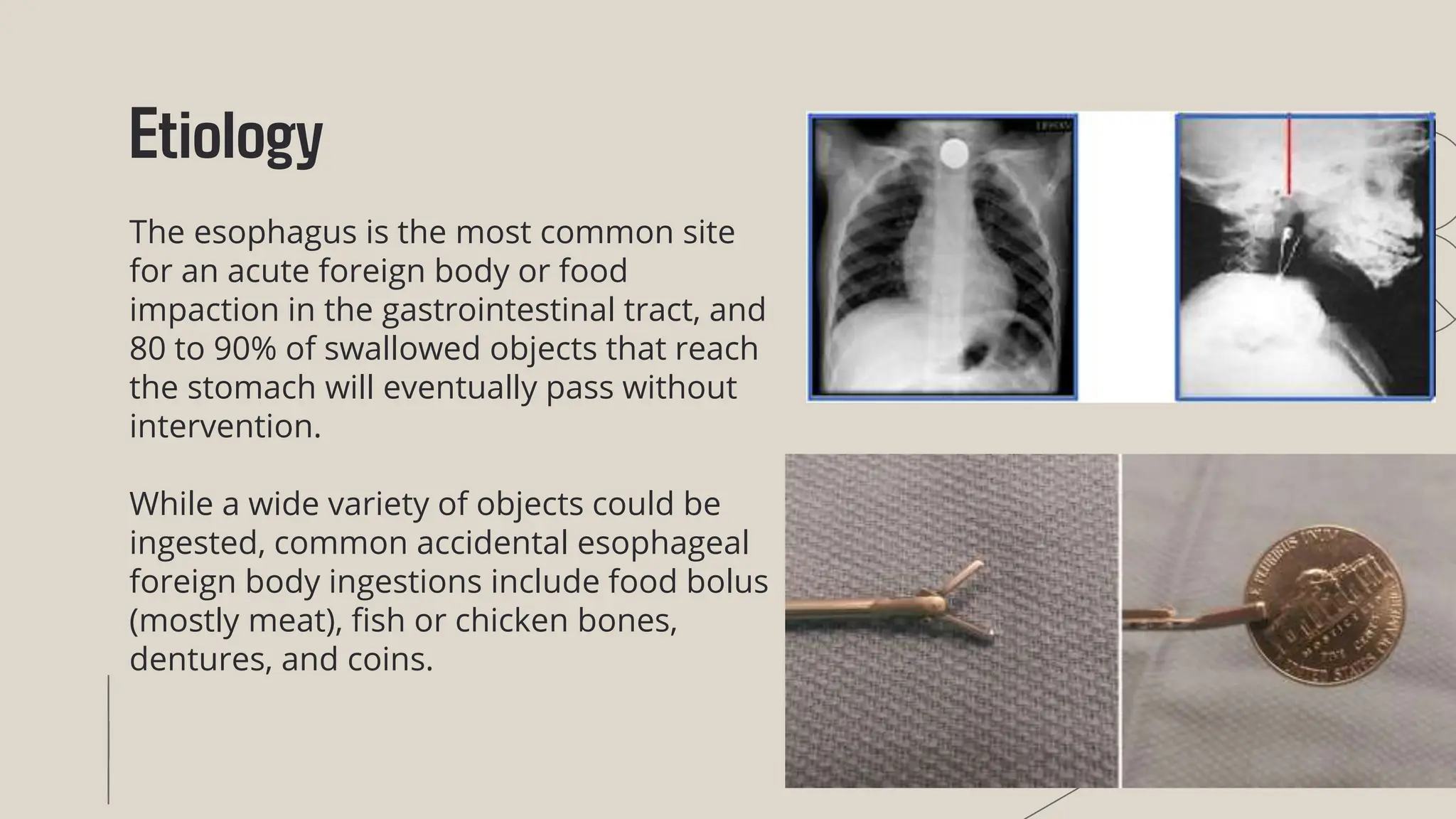 Foreign Body Obstruction - Esophagus.pptx