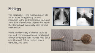 Foreign Body Obstruction - Esophagus.pptx