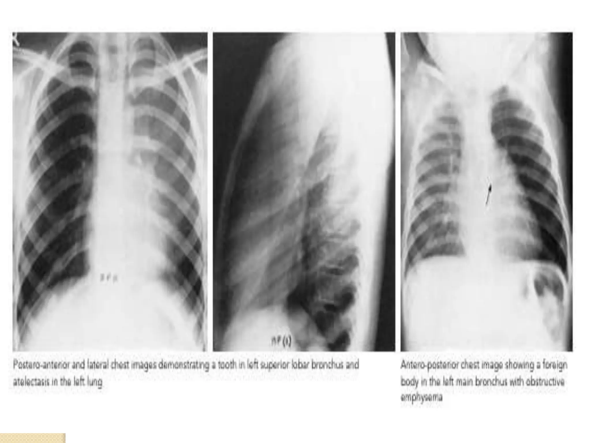 foreign body radiography.pptx