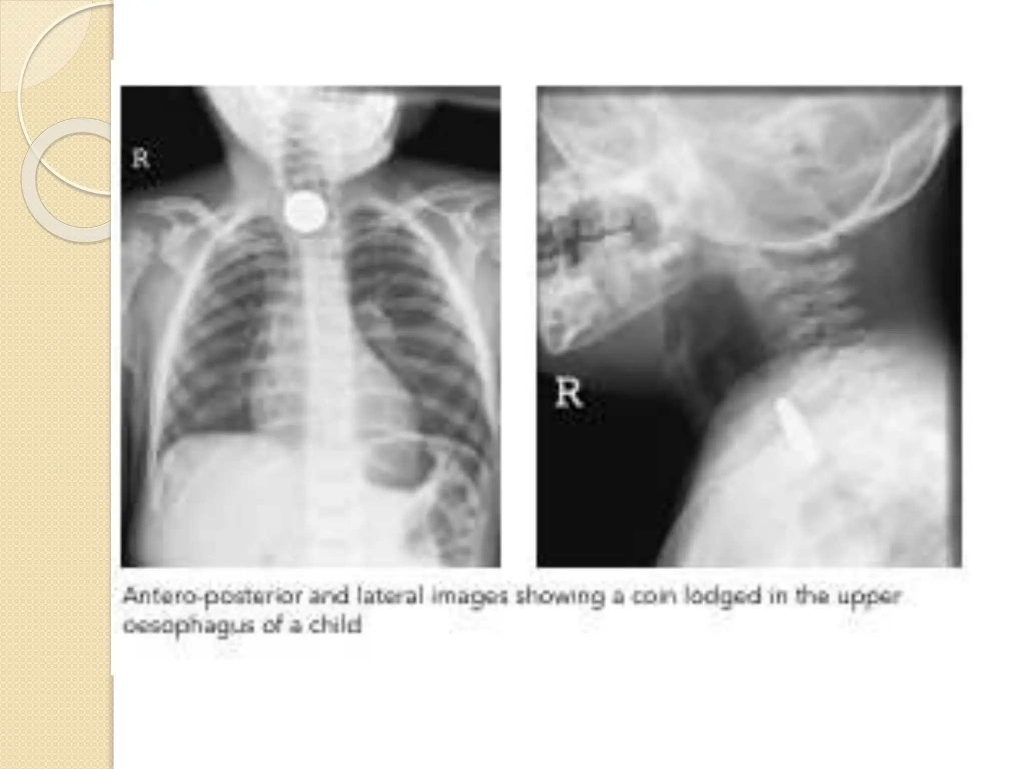 foreign body radiography.pptx