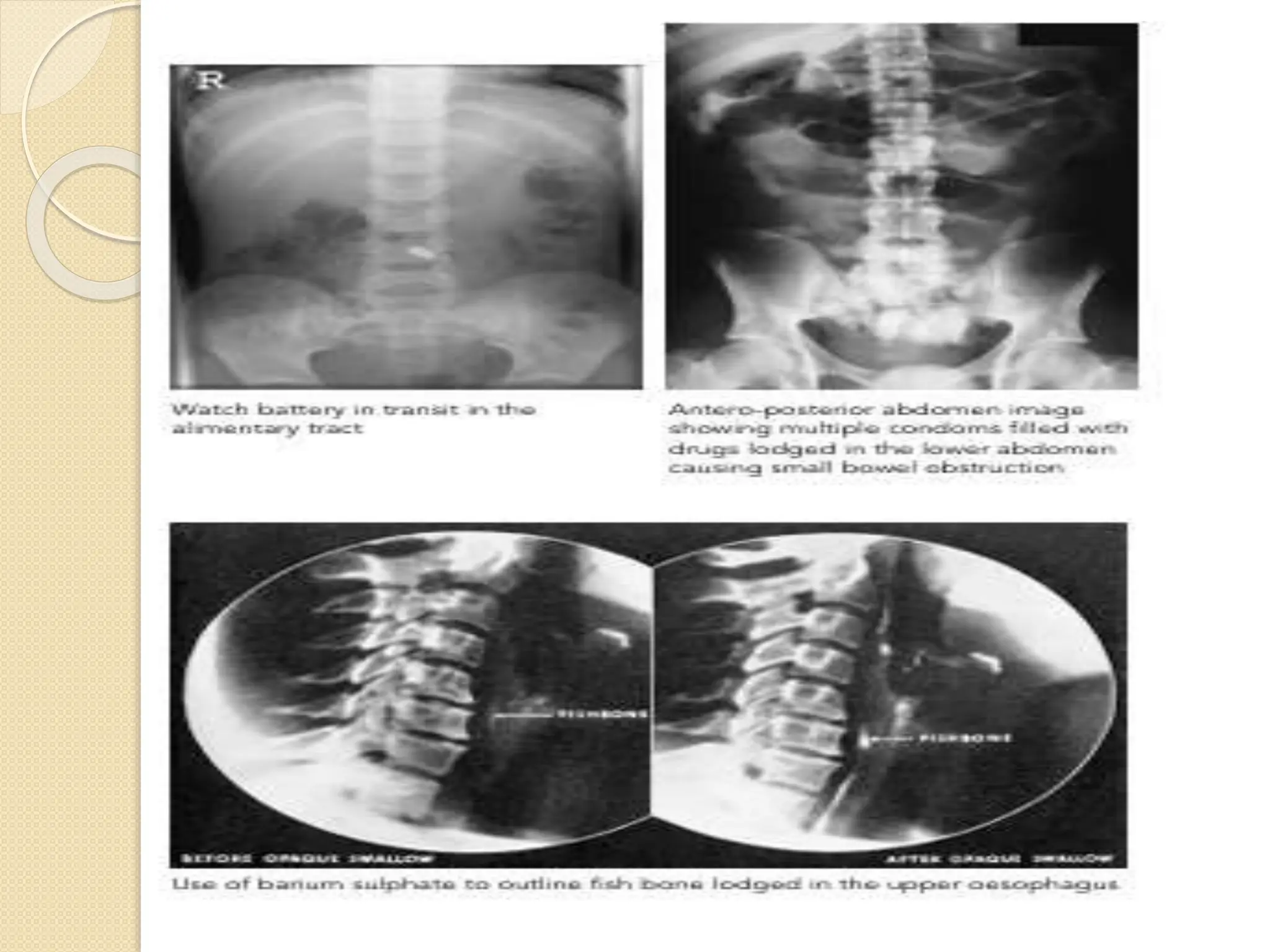 foreign body radiography.pptx