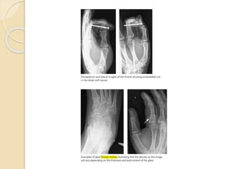 foreign body radiography.pptx